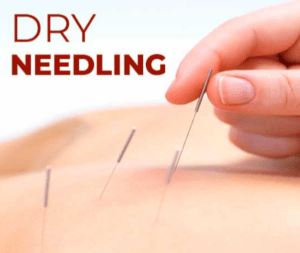 How Often Do I Need Dry Needling? - How Often Should You Do Dry ...